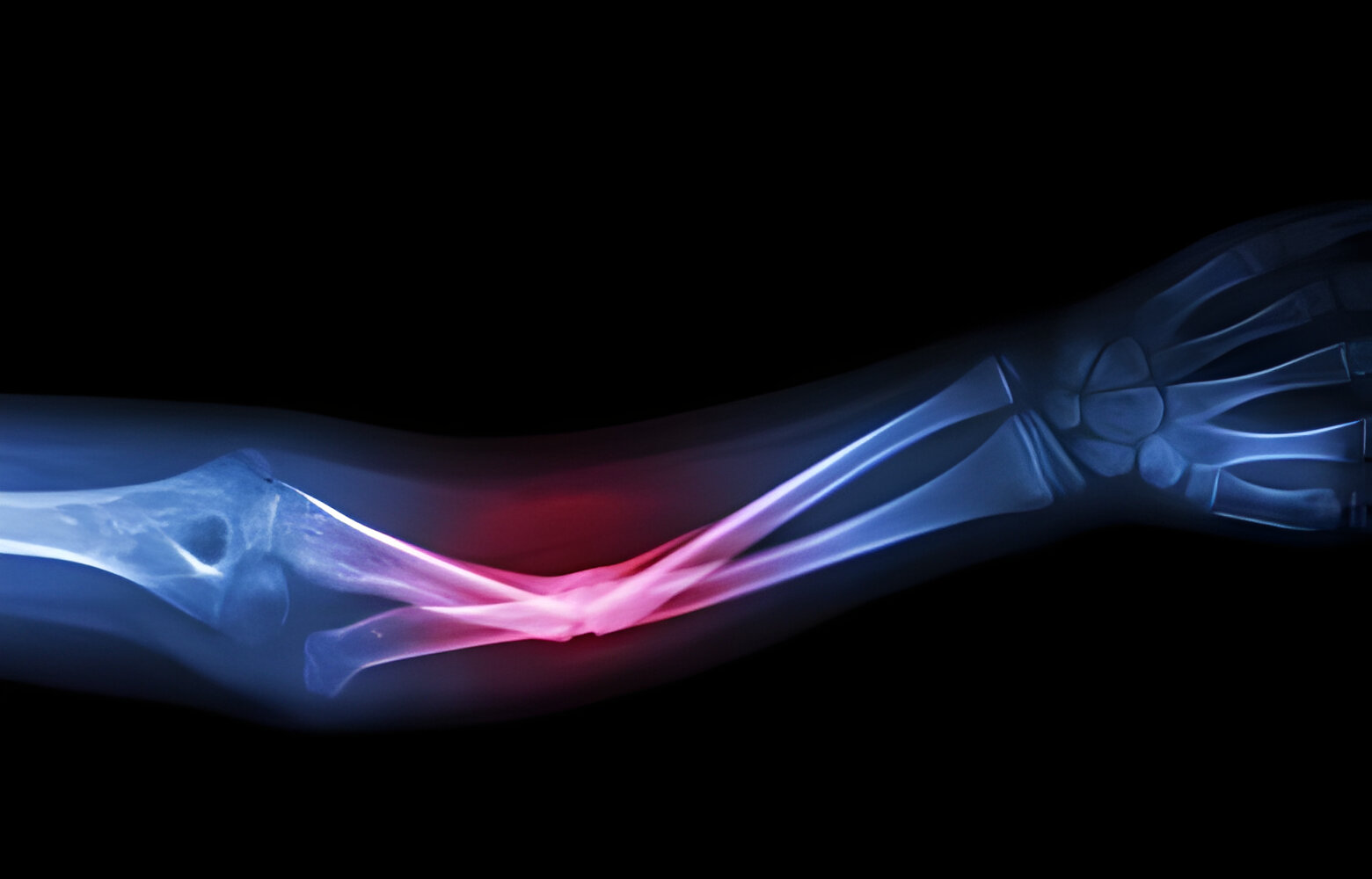 Fractures - Dr. Rohit Chakor